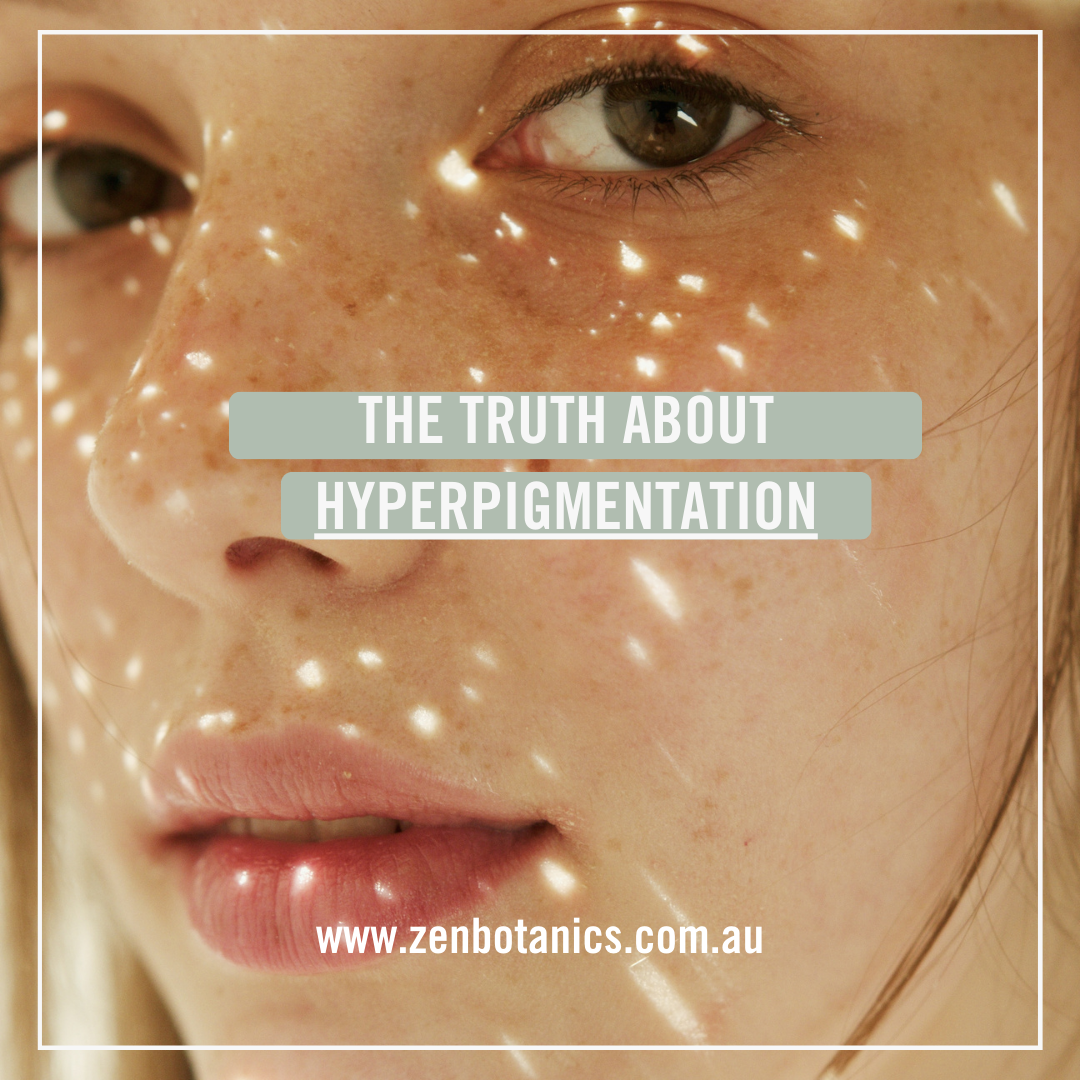 The best ingredients to use to reduce hyperpigmentation | Zen Botanics